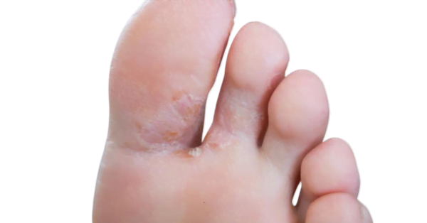 Voetschimmel (Tinea Pedis) | Symptomen en behandeling 2024