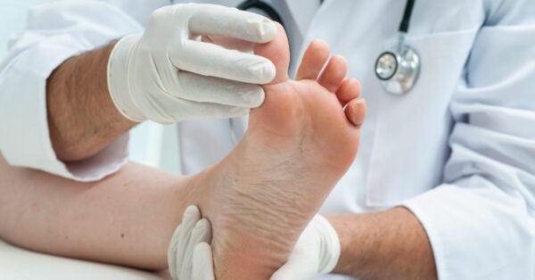 Voetschimmel (Tinea Pedis) | Symptomen en behandeling 2025