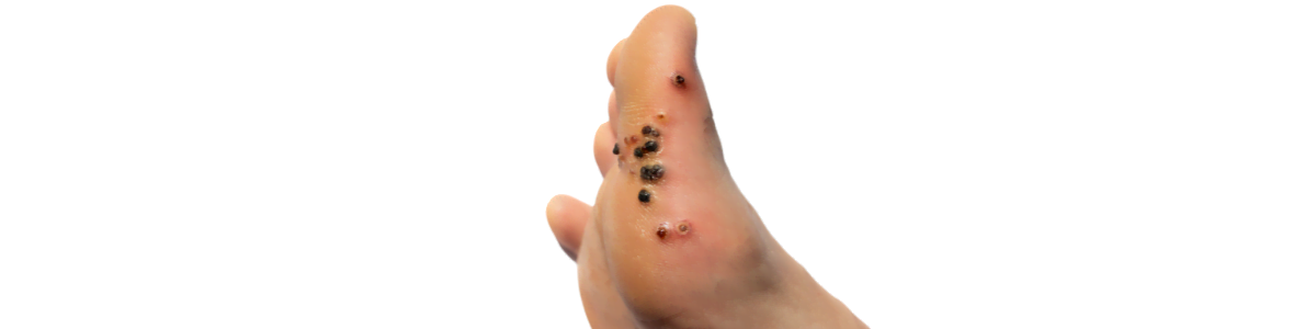 Voetwrat, wat te doen? Oorzaak en Behandeling | PediFris®