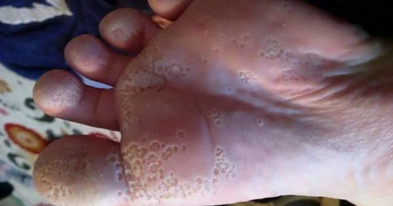 Putjeszolen | Behandelen en voorkomen